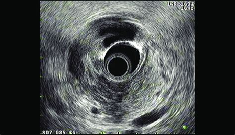 A Prominent Dorsal Ventral Pancreatic Split Interpreted On Initial Eus