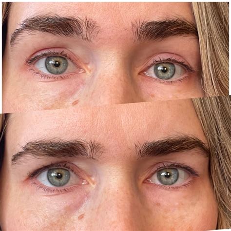 Upper Lower Bleph Or Brow Lift R Plasticsurgery