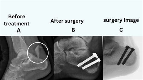 Walking On A Broken Calcaneus Heel Bone Tips For Treatment And