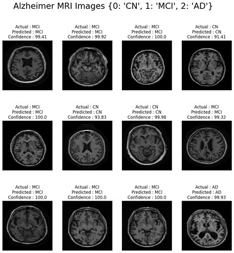 Project Alzheimer Mci Deep Learning Diagnosis Model 3 Prediction
