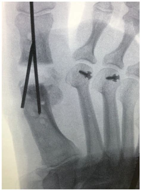 The Use Of Masquelet Technique And Impaction Bone Grafting For First Metatarsal Phalangeal Joint