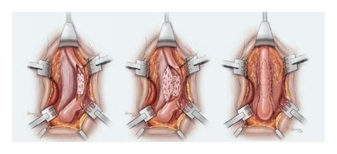 Dorsal And Ventral Buccal Graft Combination A The Urethra Is