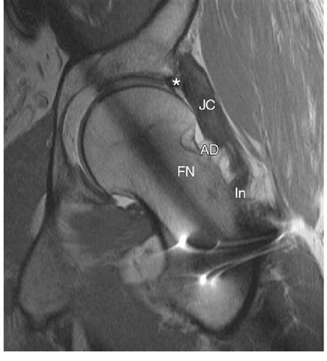 Mr Arthrogram Gadolinium Enhanced With Radial Image It Shows The