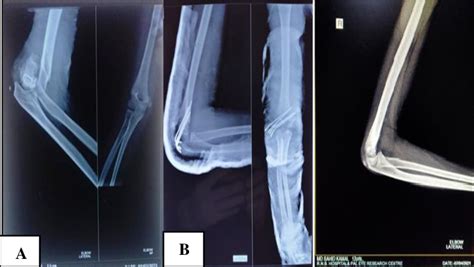 Displacement Of Fracture Download Scientific Diagram