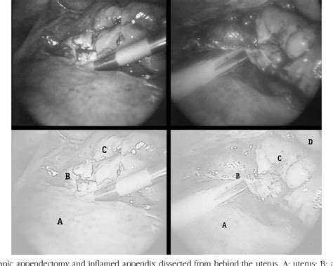 Figure 1 From Suspicion Of Acute Appendicitis In The Third Trimester Of