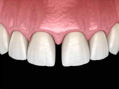 ¿qué Es Un Diastema Clínica Dental Brident Odontólogos