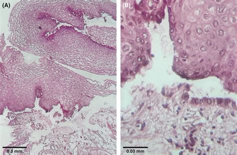 Hematoxylin And Eosin Stained Micrograph Of Oral Pemphigus Vulgaris A Download Scientific