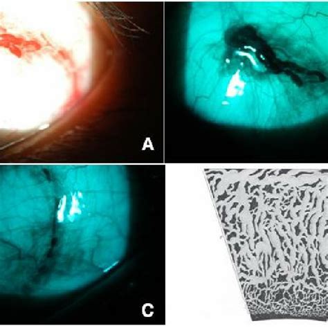 Well Visible Dilated Conjunctival Lymphatics White Arrow And Download Scientific Diagram