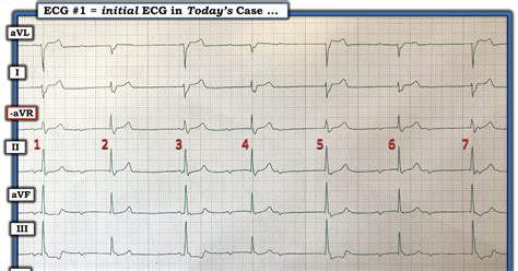 Ecg Interpretation Ecg Blog 458 — Complete Heart Block