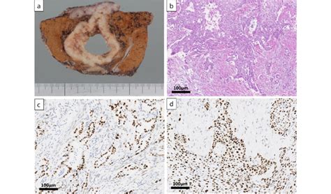 Findings Of The Excised Liver Specimen A Gross Examination Of The