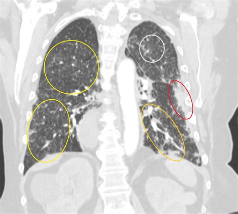 Vg Med If B76782 01 Lungs Diffuse Micronodules Subpl Consolid Ggo Bronchovasc Thickening Drug