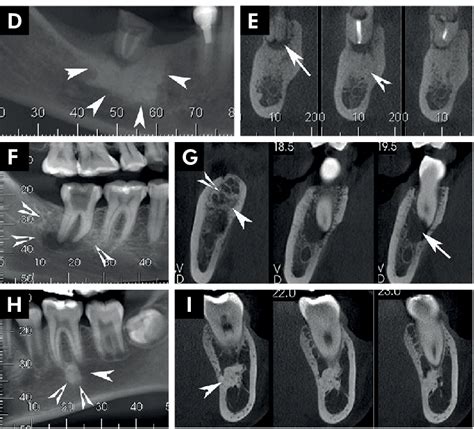 Condensing Osteitis Vs Osteomyelitis At Irving Sandoz Blog