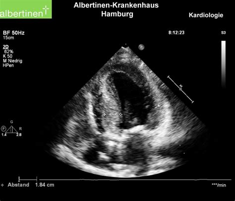 Hypertrophe Obstruktive Kardiomyopathie Hocm Echokardiographie
