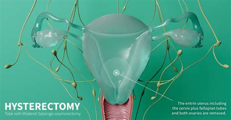 Robotic Total Hysterectomy With Bilateral Salpingo Oophorectomy Cpt