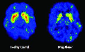 Recovery The Virtual Rehab Drug Addiction Is A Chronic Relapsing Brain