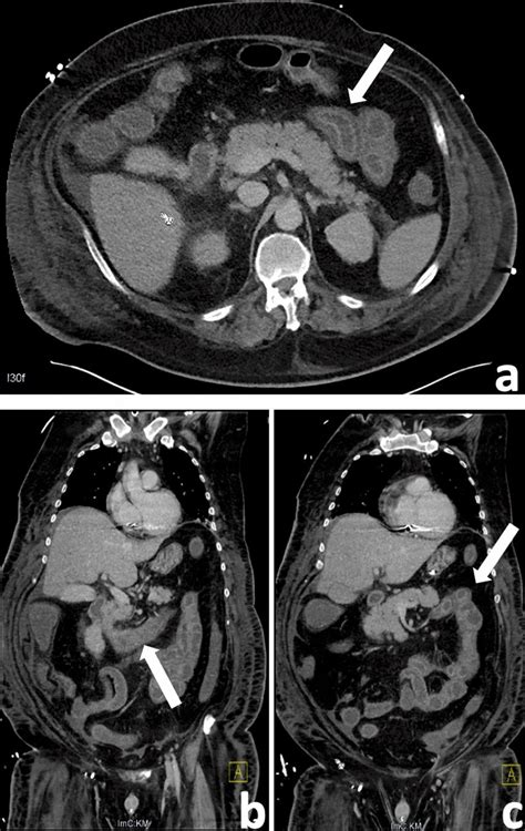 Abdominal Contrast Enhanced Ct Findings Of A 48 Y Male Patient With