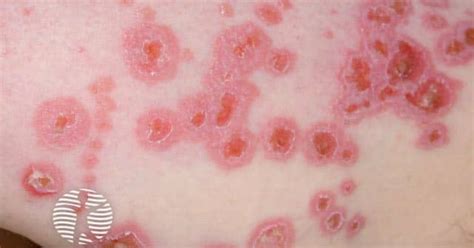 Linear Iga Bullous Disease Image