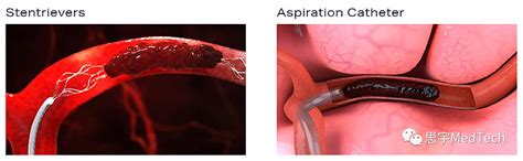 获批fda！超大口径血栓抽吸导管新进展！ 2023年12月21日，专门研发中风患者血栓清除器械的爱尔兰公司perfuze宣布旗下的两款血栓抽吸导管milliped 雪球
