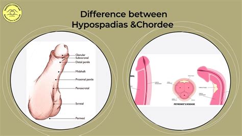 What Is The Difference Between Hypospadias And Chordee A Comprehensive