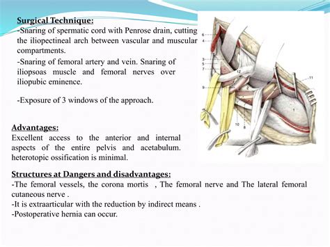 Surgical Treatment Of Associated Patterns Fracture Acetabulum Ppt