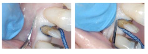 09 Gingival Displacement And Impression Making Flashcards Quizlet