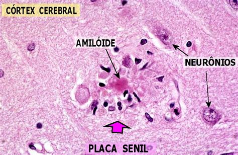Mal De Alzheimer ProteÍna Essencial Do CÉrebro Causa Morte Celular