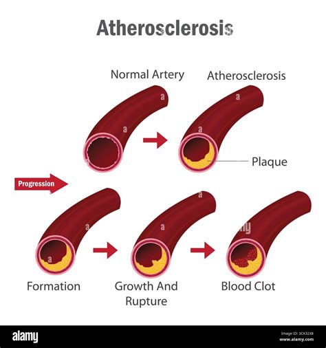 Atherosclerosis Stages Infographic Showing Artery Plaque Formation