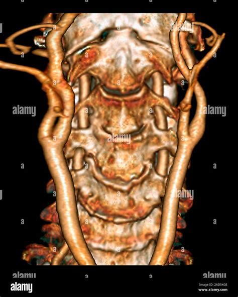 Cervical Spine And Arteries Coloured 3d Computed Tomography Ct Scan And Angiogram Showing A