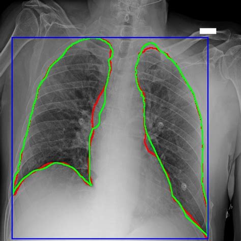Example Of The Lung Segmentation Results Green Line Manual