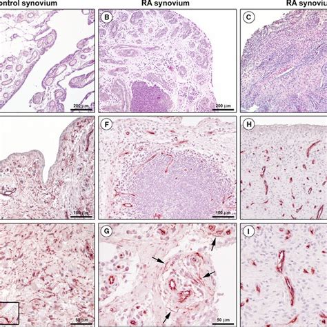 Representative Fluorescence Microscopy Photomicrographs Of Synovial