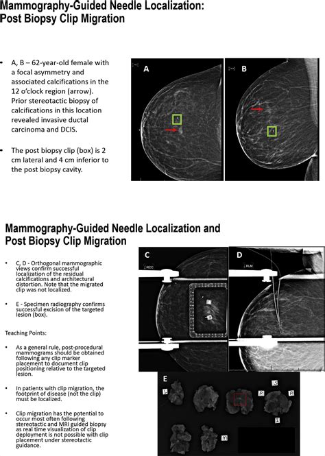 What Is A Needle Localization At Lavina Flippen Blog