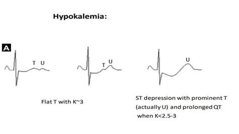 Ecg Basics Simplified For Students Pptx