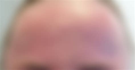 Protopic Advice Please Reczema