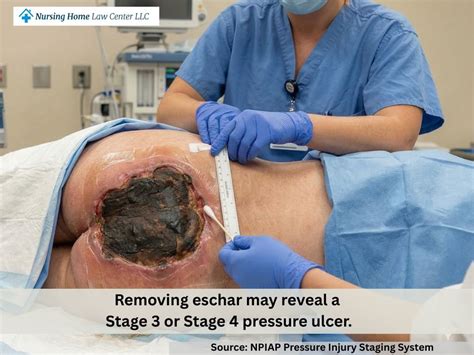 Unstageable Pressure Ulcer Definition Risks And Legal Options