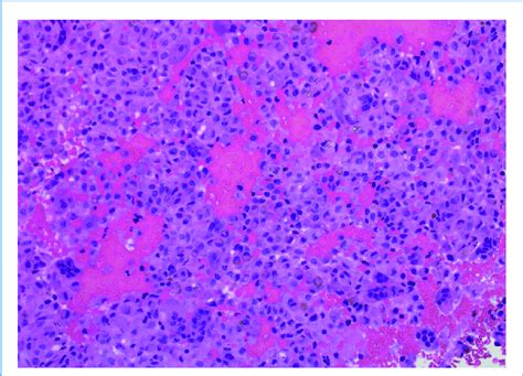 Histologic View Showing Several Multinucleated Osteoclast Like Giant