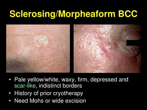 Ppt Skin Cancers Powerpoint Presentation Free Download Id6250236