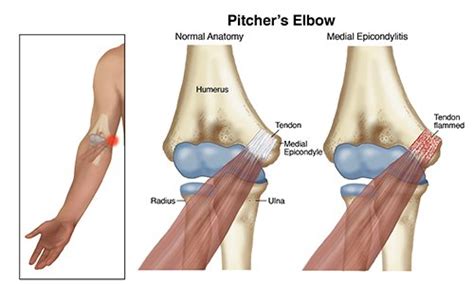 Pitchers Elbow Medial Apophysitis Physiotherapy