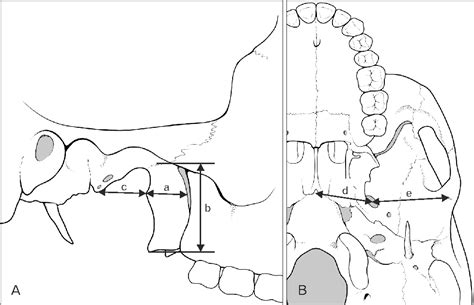 Structure Of Pterygoid Process Of Sphenoid Bone Semantic Scholar