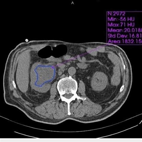 Measured Values Of Fluid In The Dilated Renal Pelvis In A Patient Download Scientific Diagram