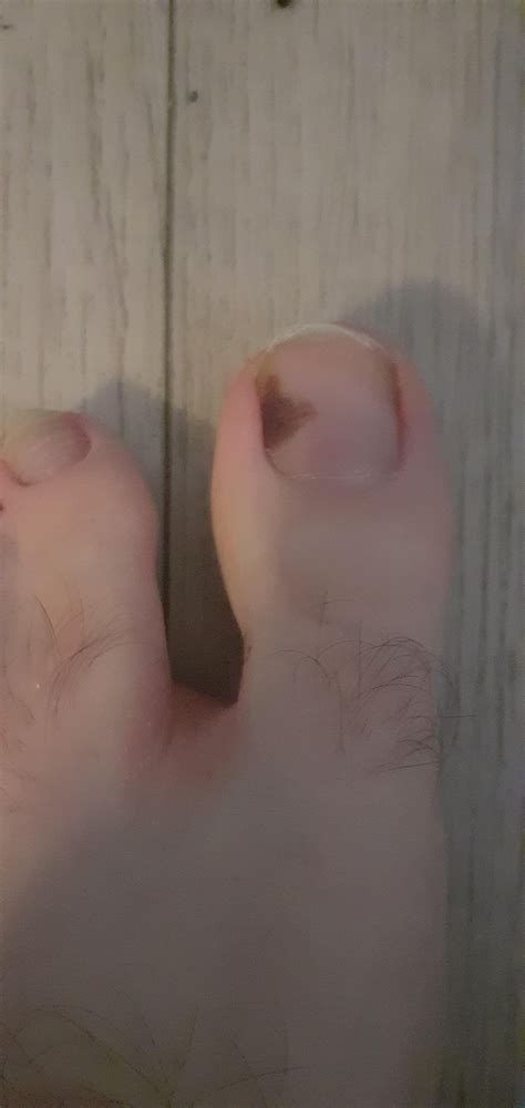 Black Spot Appeared On Toenail Roughly Two Months Ago I Dont Think