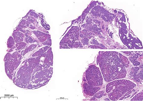 Parathyroid Gland Of A Men1 Patient In The Upper Part Of The Gland A