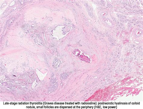 Pathology Outlines Radiation Thyroiditis