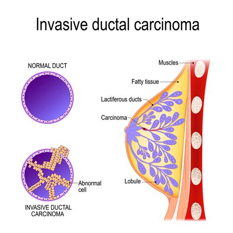 Invasive Ductal Carcinoma Diagram