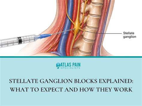 Stellate Ganglion Blocks Explained What To Expect And How They Work