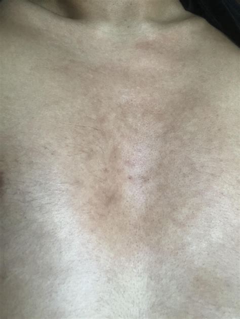 Need Help With Hyperpigmentation On Chest And Back Racne