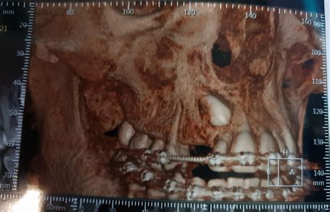 Ectopic Tooth In Nose R Popping