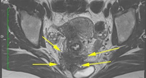 Huge Endometriosis Nodule Of Parameter Rectum Vagina Bladder And S3 Sciatic Root