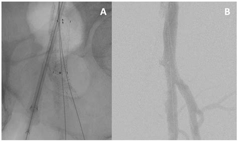 Percutaneous Endovascular Reconstruction Of The Common Femoral Artery