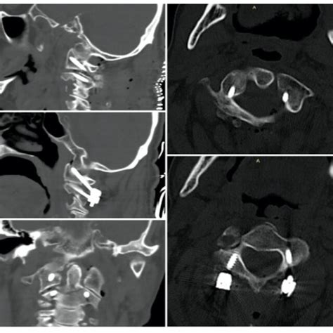 Sacrified C2 Nerve Root Is Indicated By Arrows Download Scientific