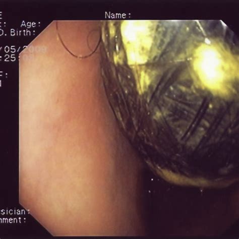 Confluent Dermatitis Artefacta Lesions On The Upper And Lower Limbs